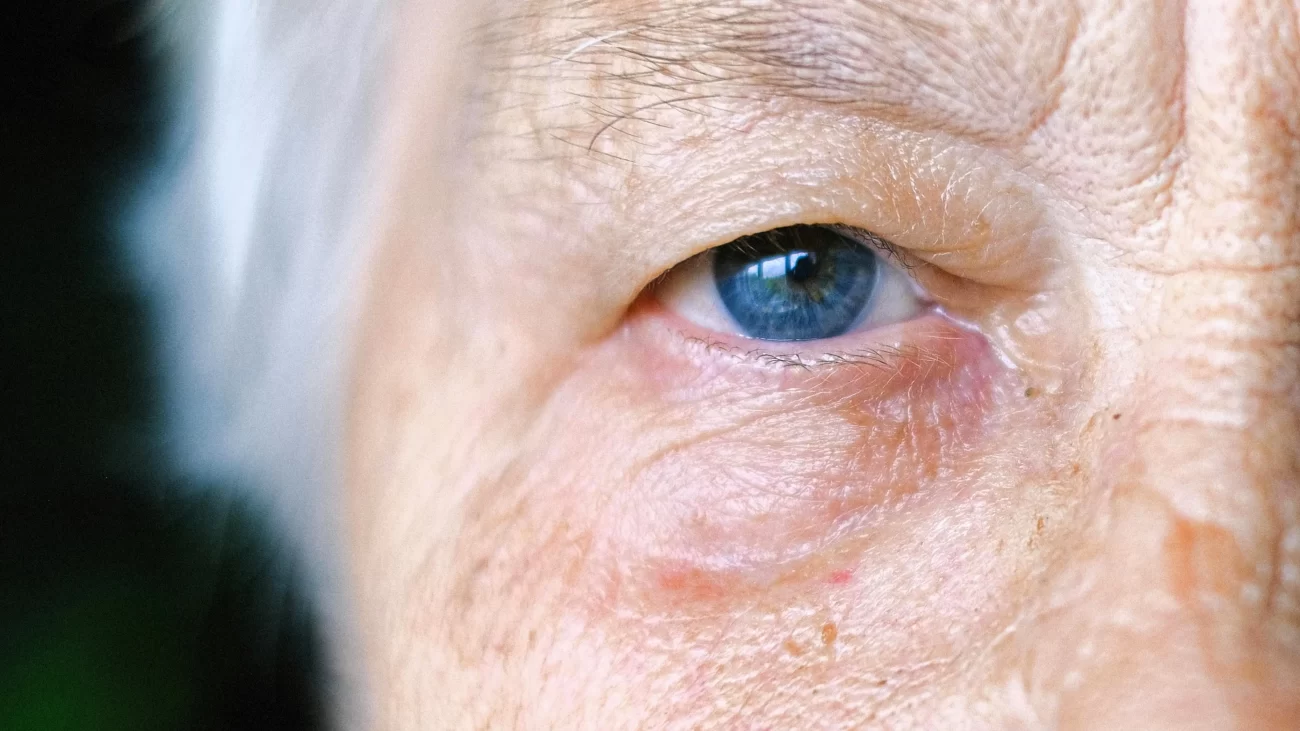 Cum Combatem Petele Pigmentare